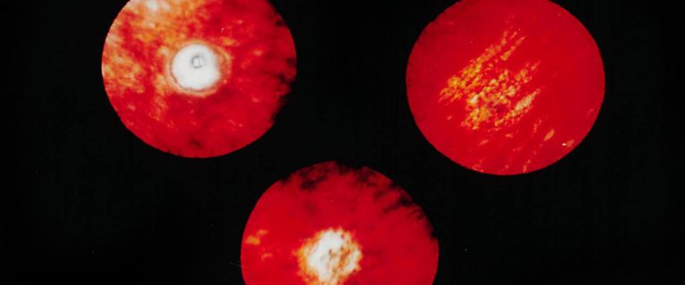 NewYork-Presbyterian | The Ruby Laser's First Medical Use