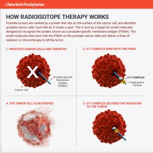 Targeting Advanced Prostate Cancer | NewYork-Presbyterian