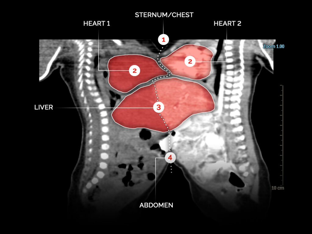 Inside the Successful Separation Surgery of Conjoined Twins