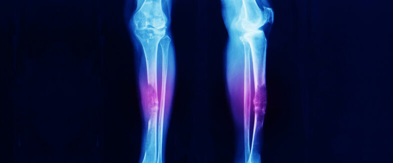 Bone Cancer: What to Know - NewYork-Presbyterian - Oncology