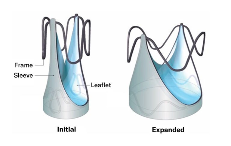 At 8, a Heart Pioneer