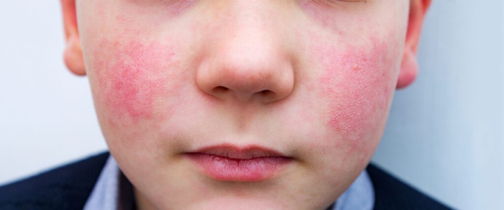 What to Know About Parvovirus: Symptoms and Treatments