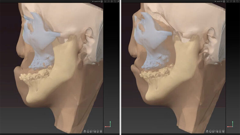 A Teenage Girl Finds Her Smile After a Series of Reconstructive Surgeries